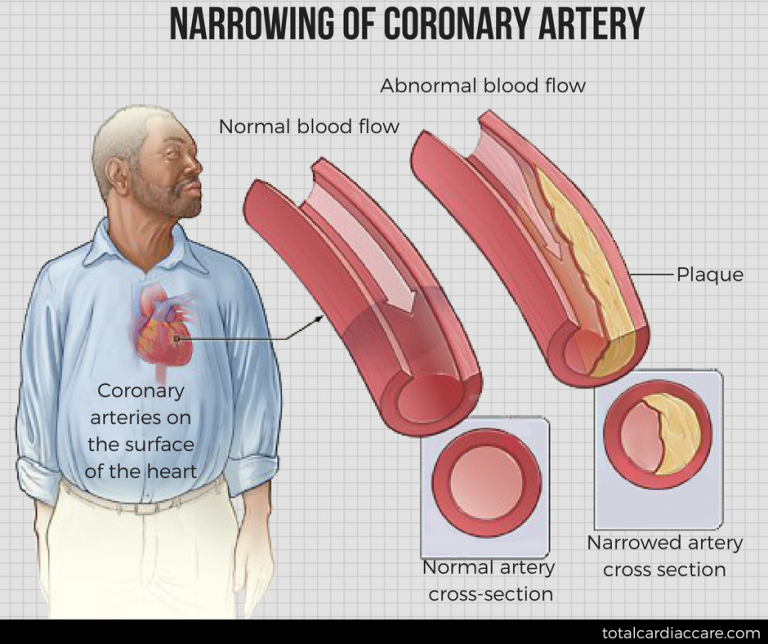 What is Bypass Surgery? - Dr. Mahadevan, Total cardiac care