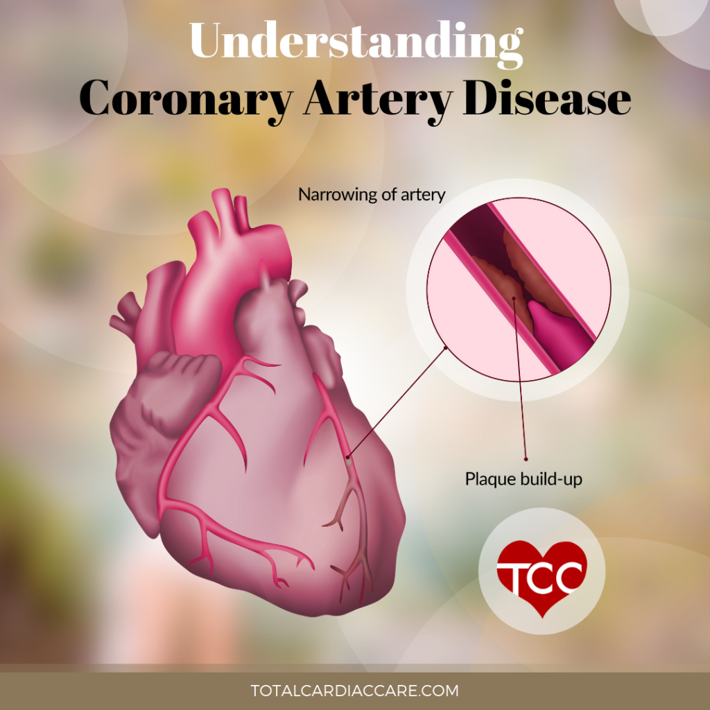 Understanding Coronary Artery Disease (CAD) | Total Cardiac Care